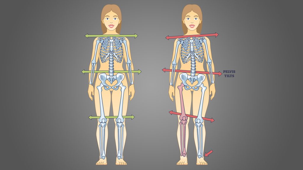 Trendelenburg Gait Exercises Gait Cycle | Charschan Chiropractic In