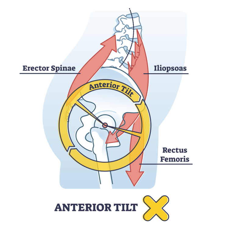 Anterior Pelvic Tilt: 3 Stretches and 3 Exercises to Remedy - Inspire US
