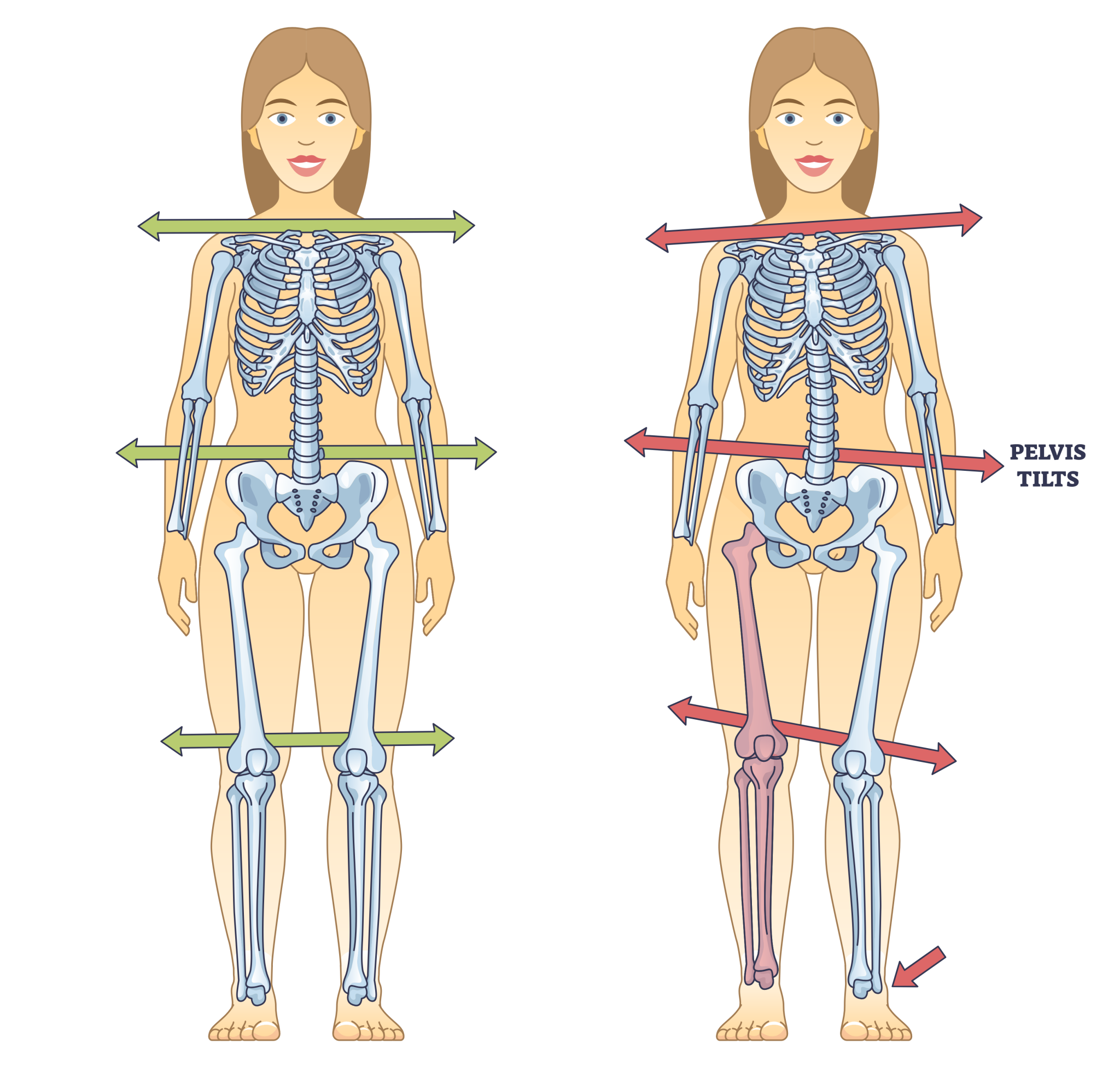 7 Best Trendelenburg Gait Exercises (with Pictures!) - Inspire US